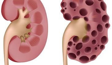 Cystic Kidney Disease Treatments